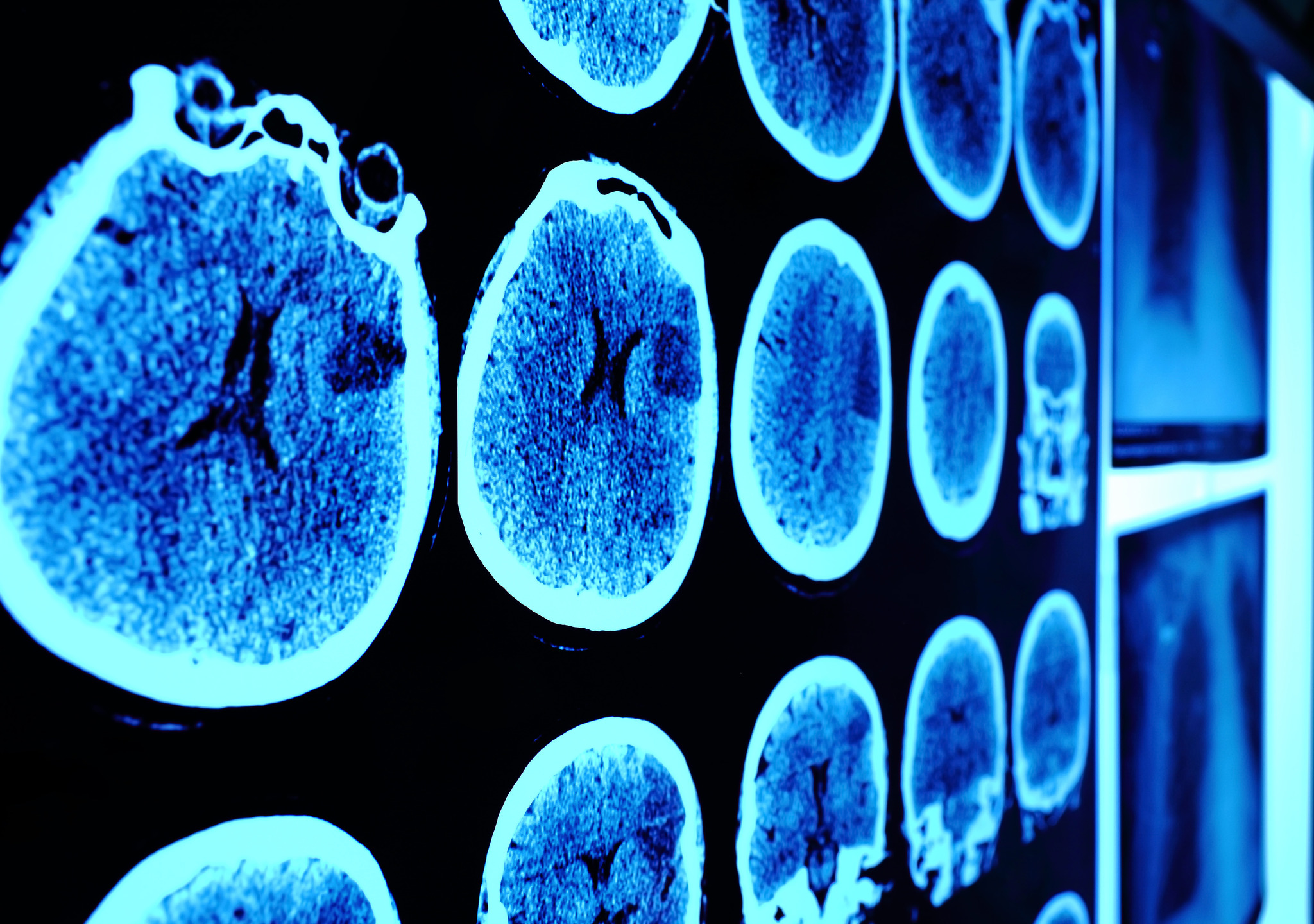 Seltener Krebs: Gehirntumor